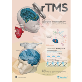 rTMS (Repetitive Transcranial Magnetic Stimulation) Poster
